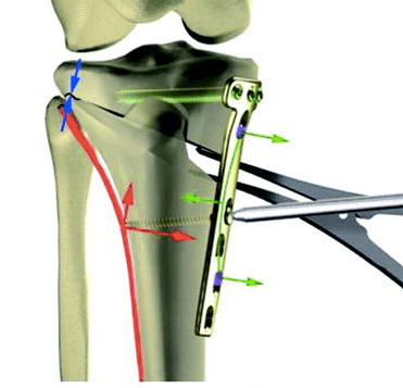 High Tibial Osteotomy - Dr Shannon Sim