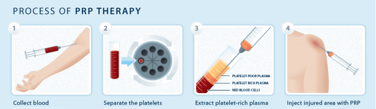 Platelet Rich Plasma Injections (PRP) - Dr Shannon Sim