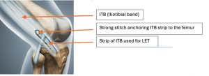 Lateral Extra-Articular Tenodesis (LET) - Dr Shannon Sim